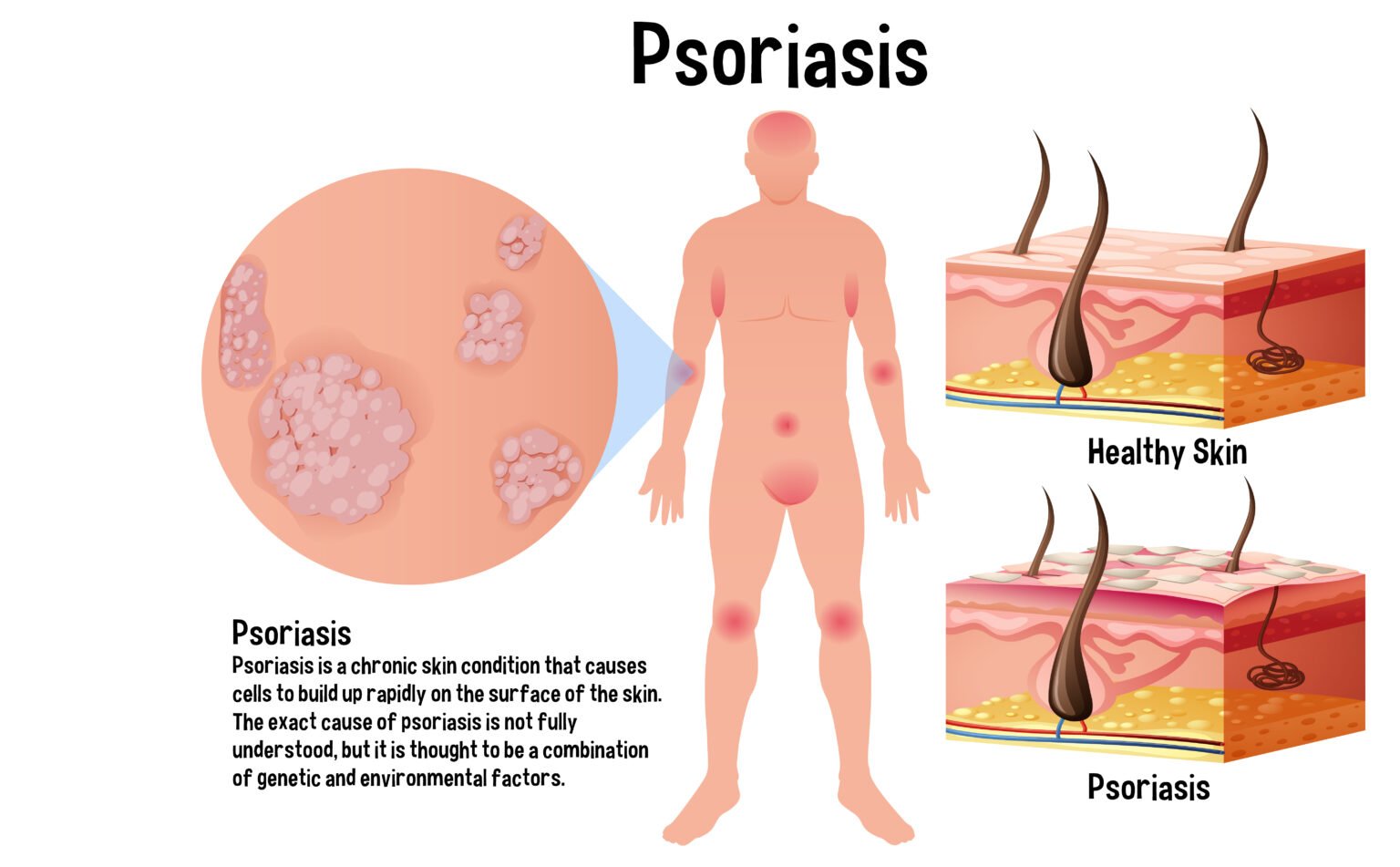 Psoriasis – Laser Treatment – Dr. Kritika Derma Clinic